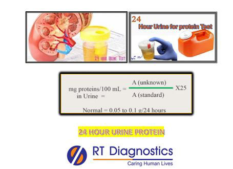 24 Hr Urine Protein | RT Diagnostics