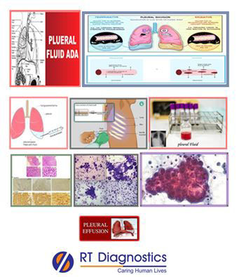 ADA - Pleural Fluid | RT Diagnostics