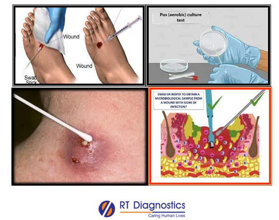 Culture & Sensitivity - Wound Swab | RT Diagnostics