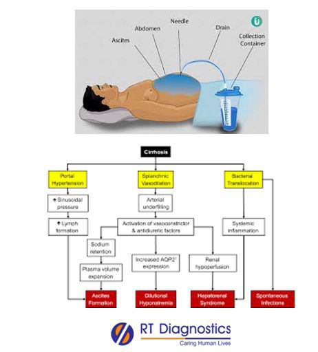 Chloride - Ascitic Fluid | RT Diagnostics