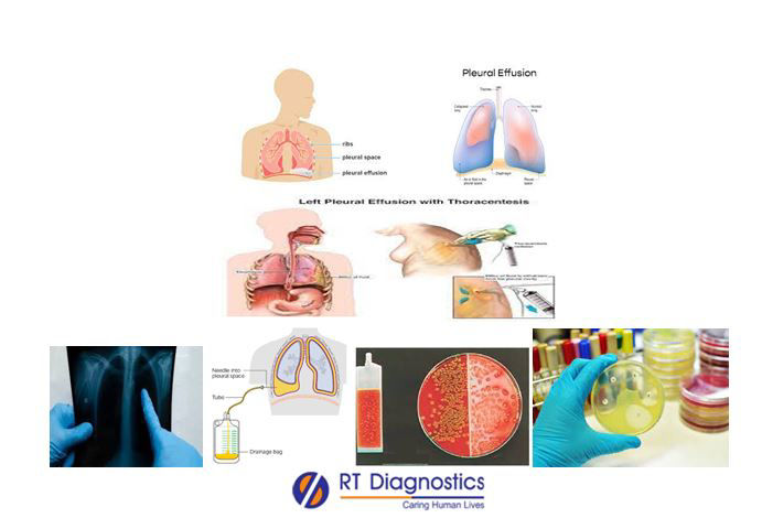 Culture & Sensitivity - Pleural Fluid | RT Diagnostics