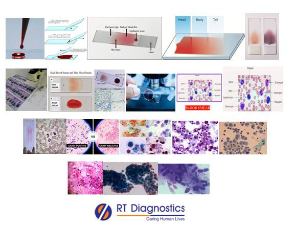 Peripheral Blood Film | RT Diagnostics