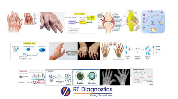 RA Factor | RT Diagnostics