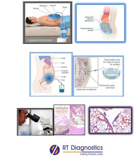 Cytology - Peritoneal Fluid | RT Diagnostics
